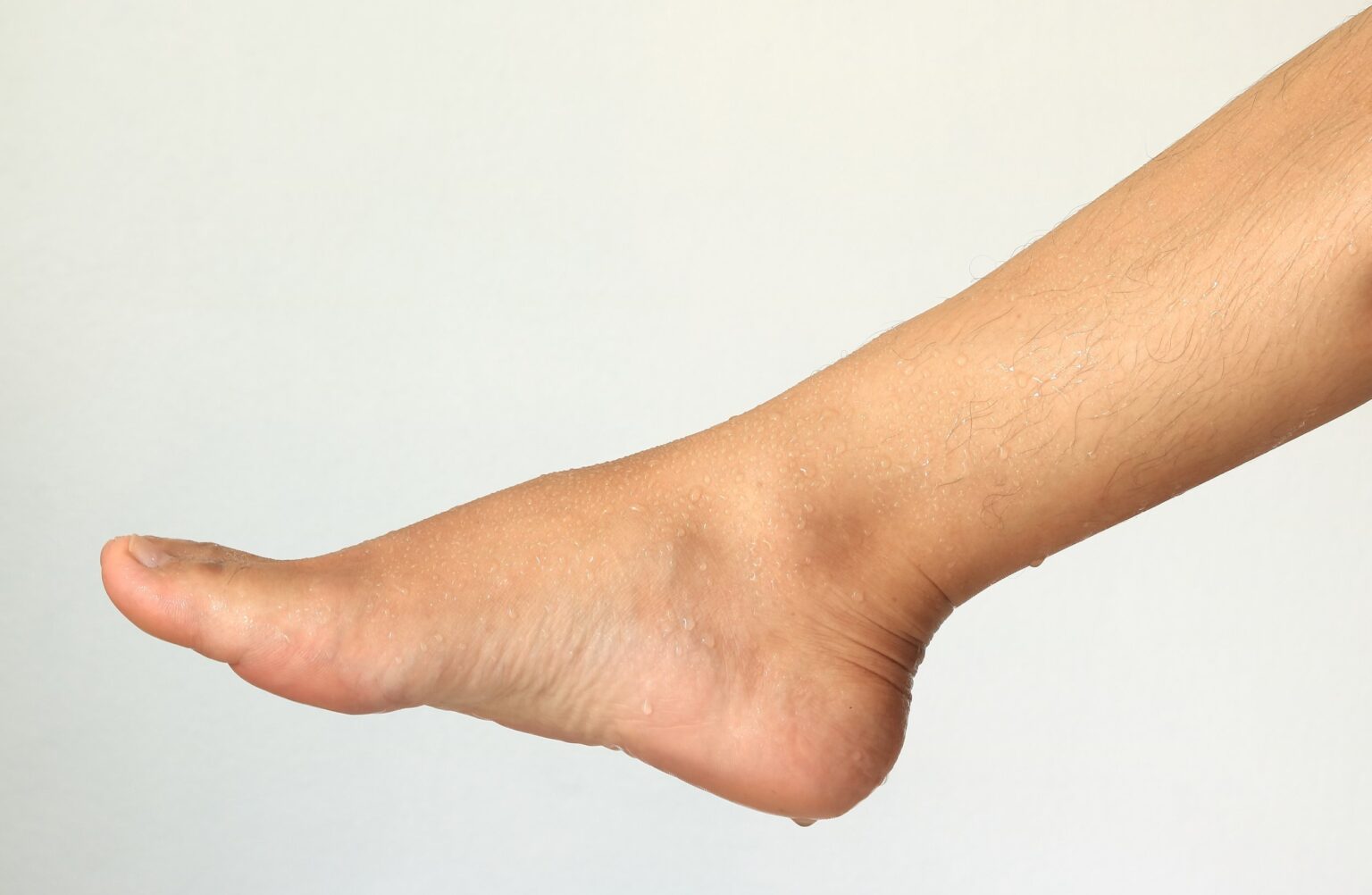 Plantar Hyperhidrosis: Is There a Cure For Hyperhidrosis in the Feet ...