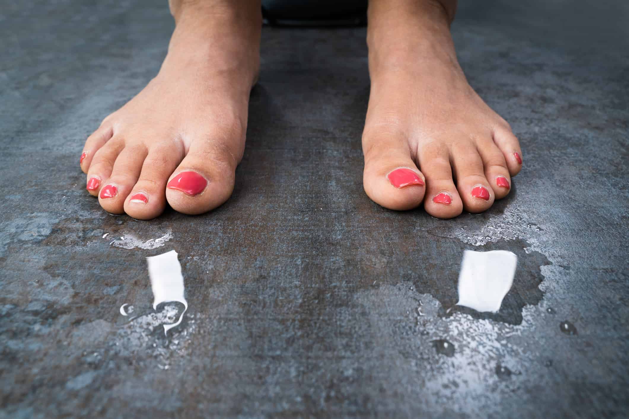 Plantar Hyperhidrosis: Is There a Cure For Hyperhidrosis in the Feet ...